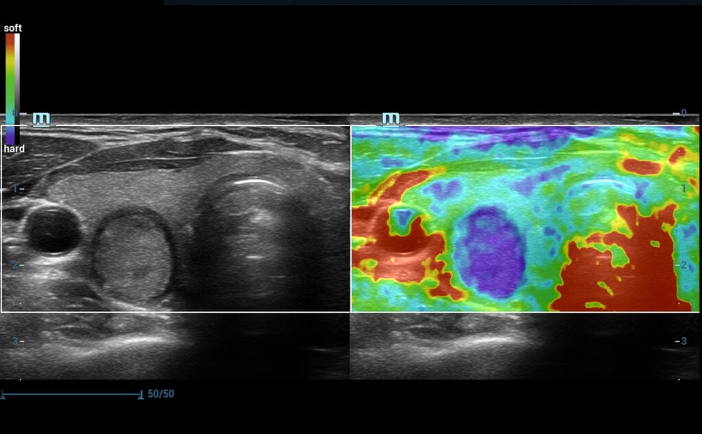 Elastografi : Metode Pemeriksaan Organ Hati Terbaru, Begini Cara ...